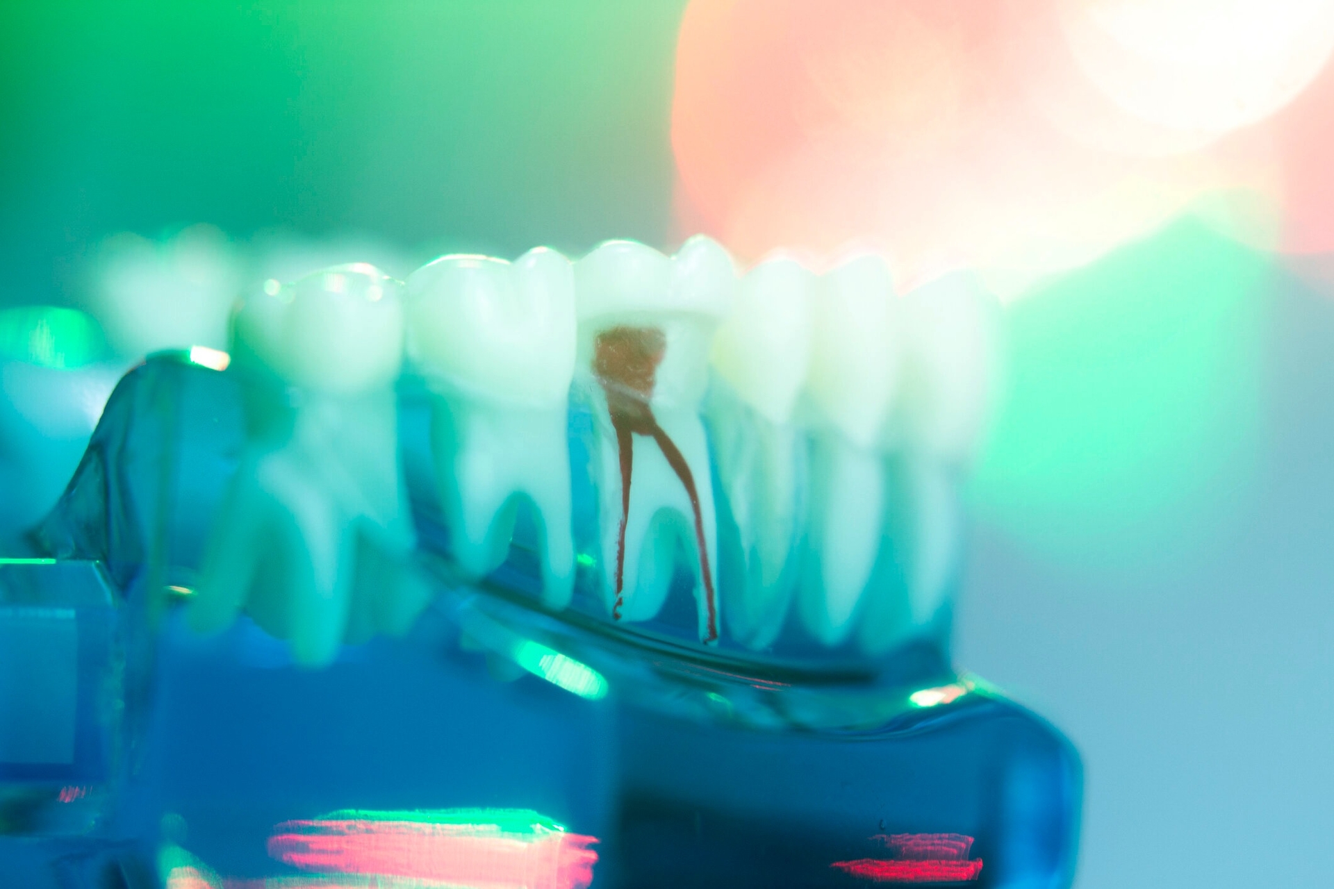 Root Canal Rancho San Diego CA Simhairy Dental Root Canal Rancho San Diego CA Simhairy Dental